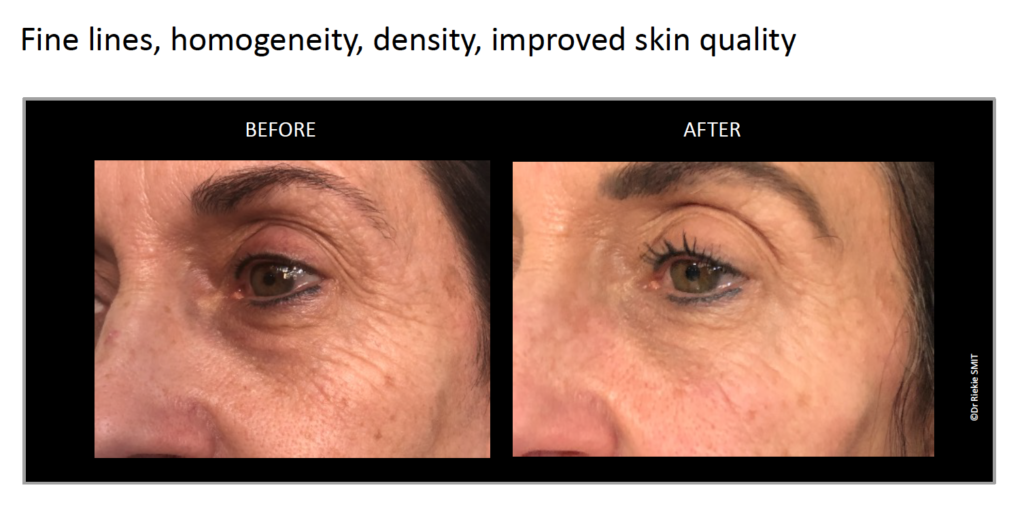 Mesotherapy Bio-rejuvenation | The Wicklow St Clinic